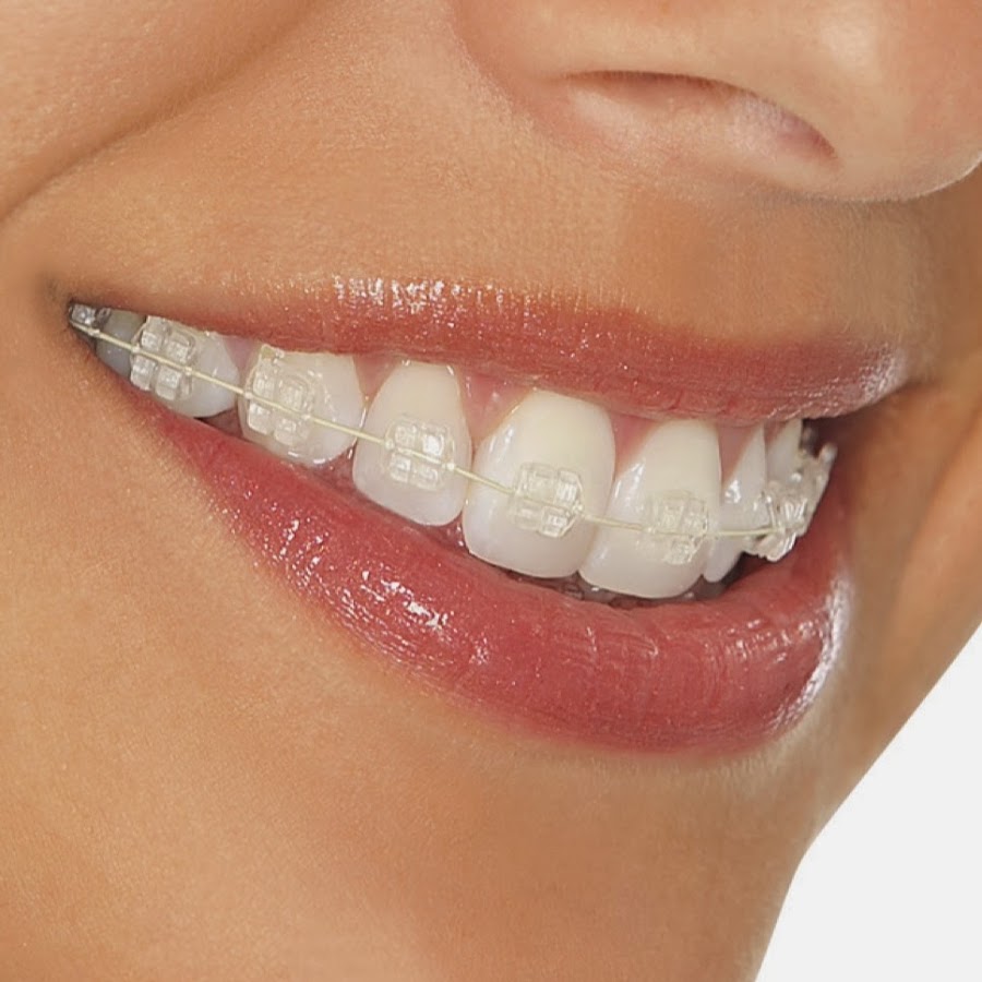 Aparelho fixo, aparelho ortodôntico e alinhador – DRA. JAQUELINE TELES ...